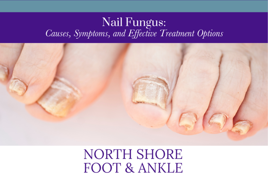 Nail Fungus: Causes, Symptoms, and Effective Treatment Options | North ...
