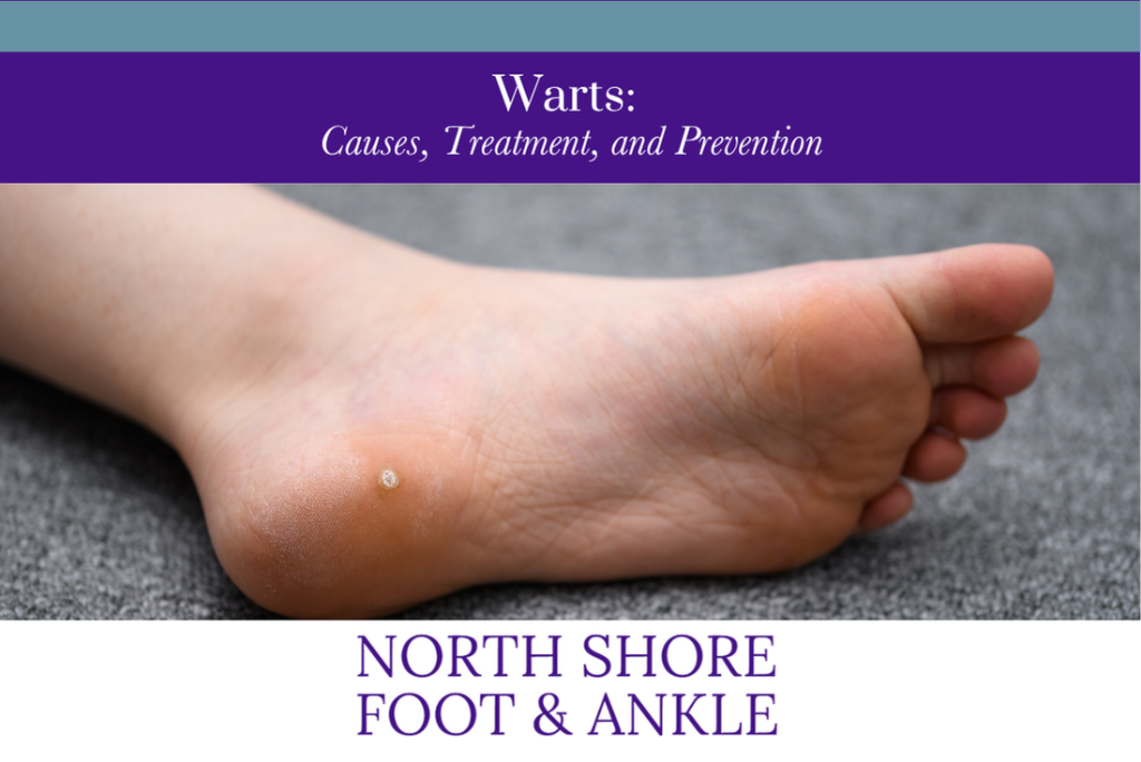 Warts: Causes, Treatment, and Prevention | North Shore Foot & Ankle